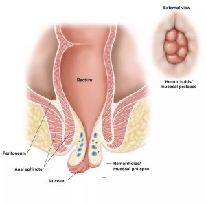 Hemoroid (Basur) Nedir | Hemoroid Belirtileri Ve Tedavisi