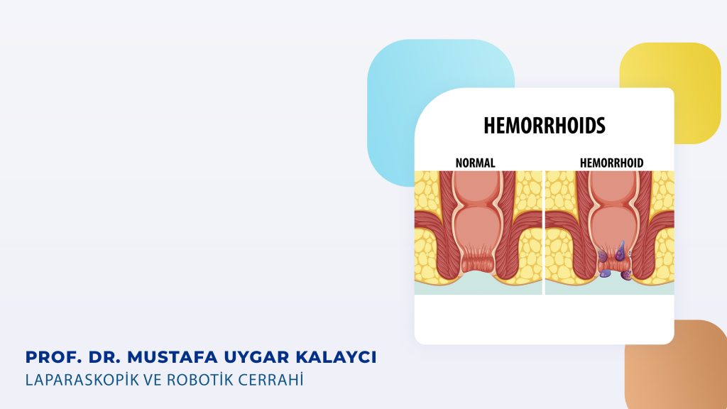 Hemoroid (Basur) Nedir | Hemoroid Belirtileri Ve Tedavisi
